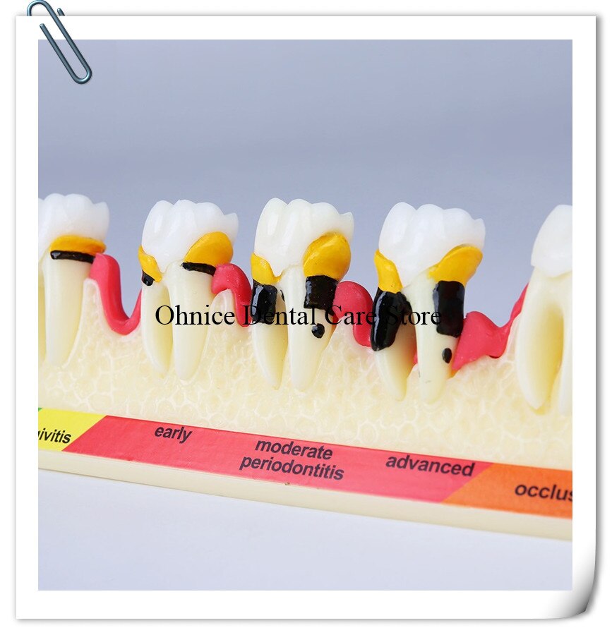 Dental Parodontitis Tand Model M4010/Pathologische... – Vicedeal