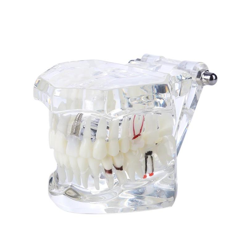 Transparent Disease Teeth Model Dental Implant Tee... – Grandado