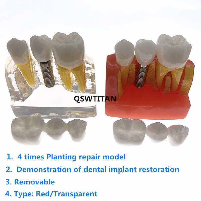 Dental 4 times planting Teeth model Analysis Crown... – Vicedeal