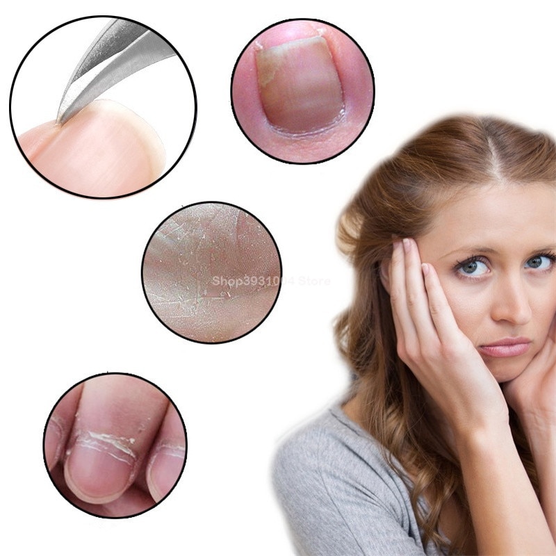 Ingrown Toenails Pedicure Foot Care Tool Nail Corr... – Vicedeal