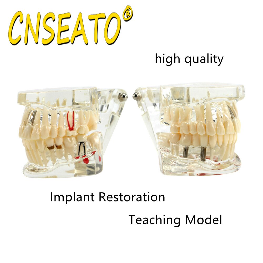 1 PC Dental Implant Restoration Model Teeth Bridge... – Grandado