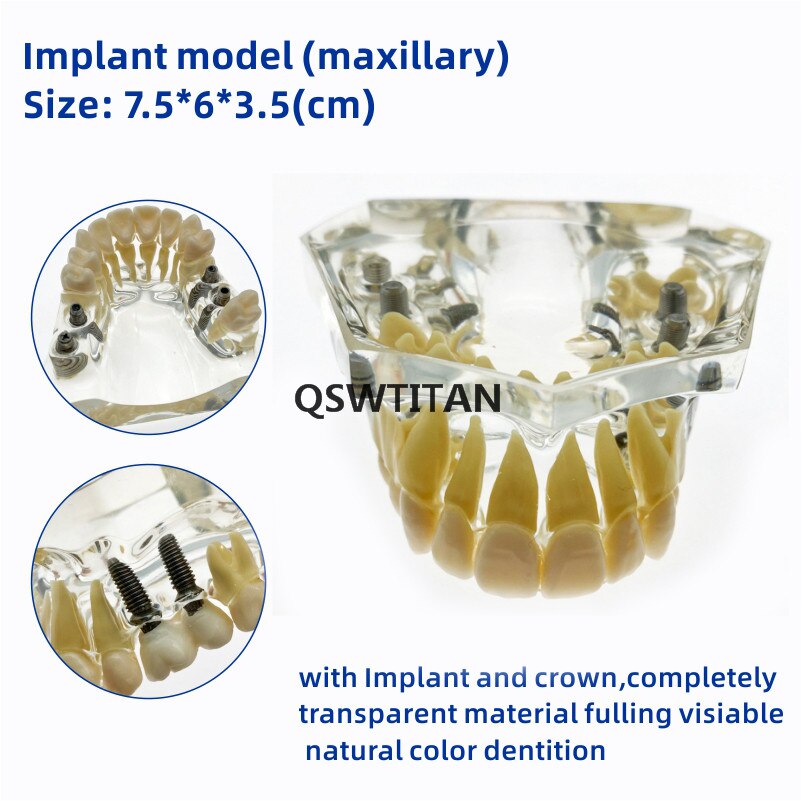 Dental Implant model Upper/Lower jaw with bridge a... – Grandado Dental Implant model Upper/Lower jaw with bridge a... – Grandado
