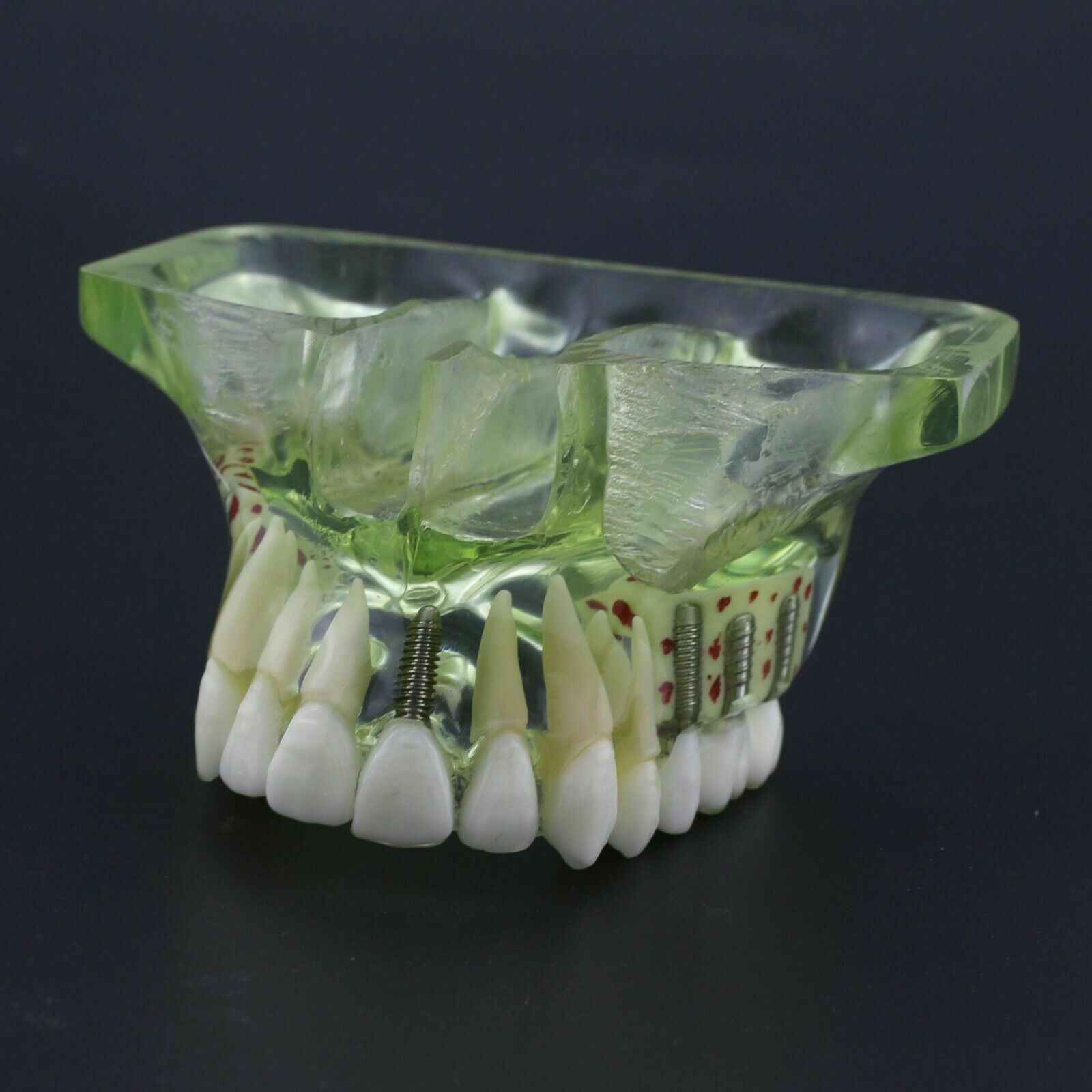 Dental Teaching Model NISSIN Kilgore Implant Model... – Grandado