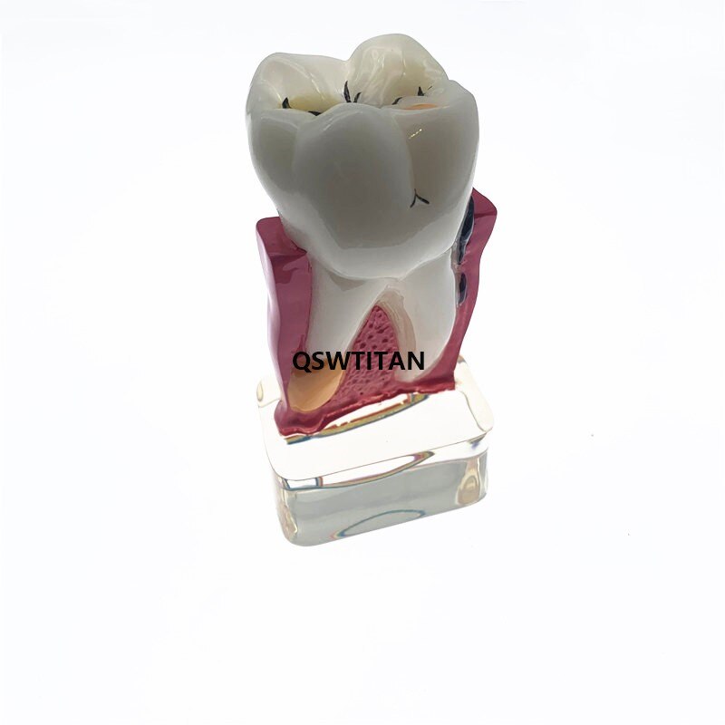 Teeth Model 4 times tooth pathology model Comprehe... – Vicedeal