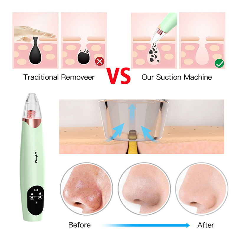 CkeyiN 3 In 1 Blackhead Remover Vacuum Suction Fac... – Grandado