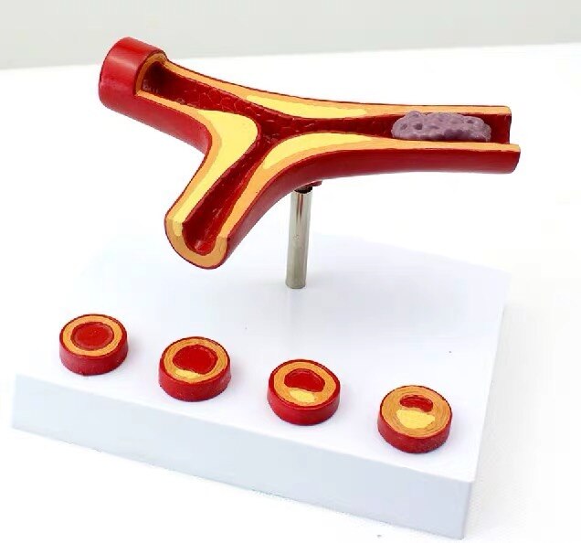 Arteriosclerose Model Met Trombus Voor Menselijk S... – Vicedeal