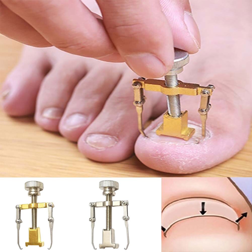 Ingrown Toenail Toe Fixer Recover Correction Devic... – Grandado