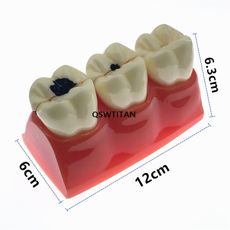 Teeth Model Caries Comparation Study Models 4Times... – Vicedeal