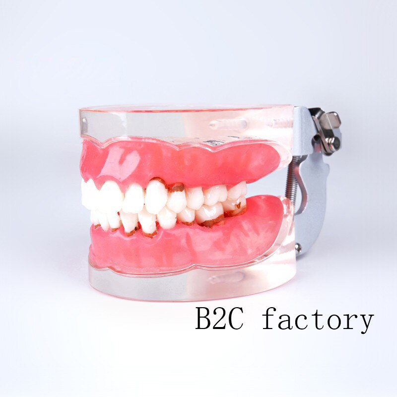 Dental Typodont Teeth Model Adult Pathological Per... – Vicedeal
