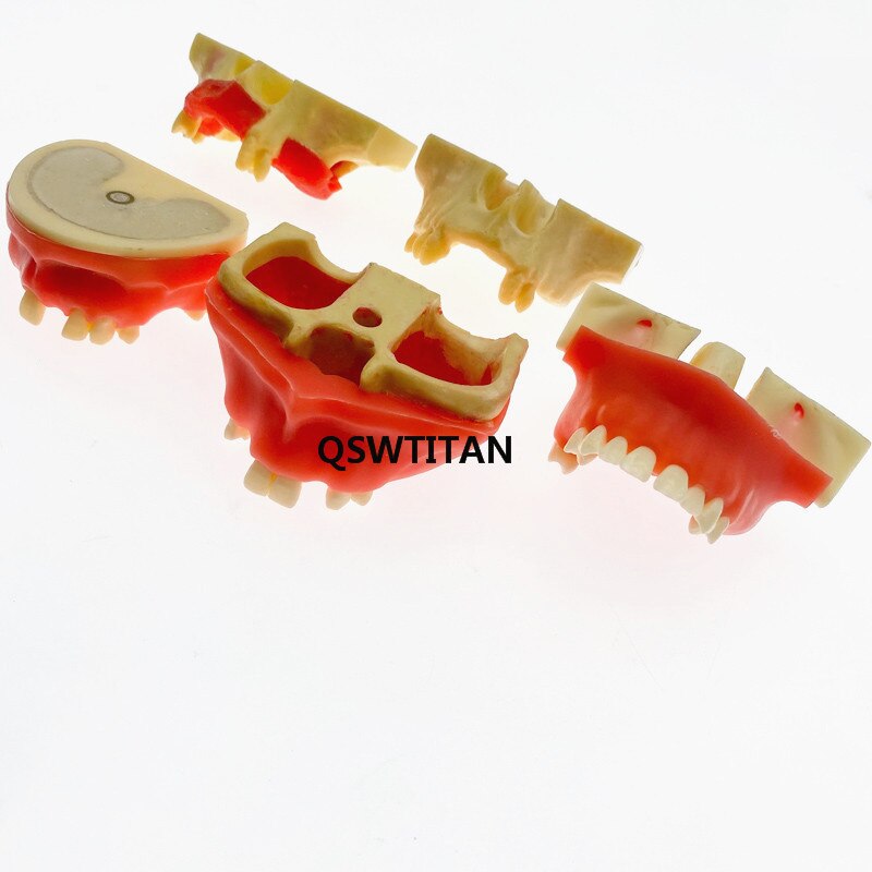 Dental model Sinus Lift Practice Teeth Model Typod... – Grandado