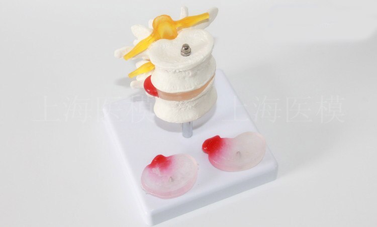 Two Section of lumbar disc disease model umbar dis... – Vicedeal
