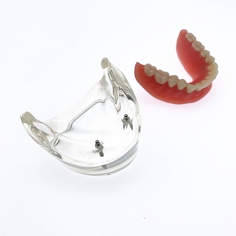 Dental Overdenture Teeth Model Removable Interior ... – Grandado