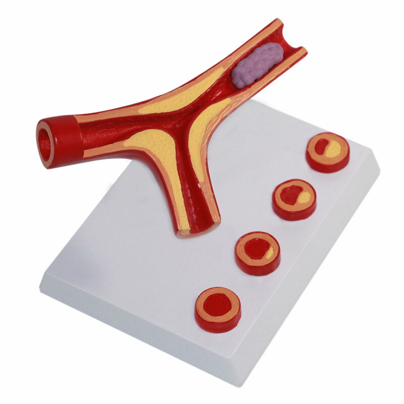 Human Arterial Atherosclerosis Arteriosclerosis Mo... – Grandado