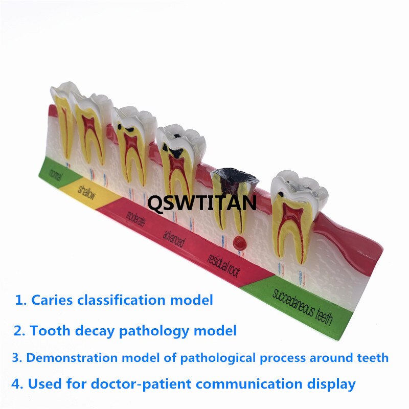 Dental caries classify model Tooth Model of pathol... – Vicedeal