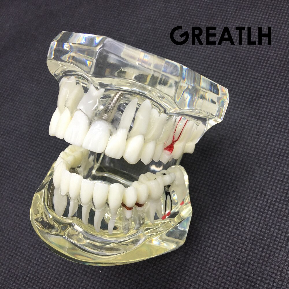 Dental Implant Disease Teeth Model With Restoratio... – Vicedeal