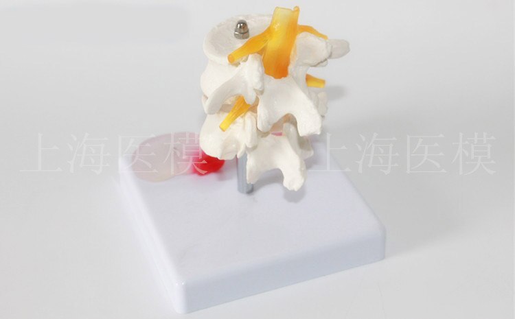 Two Section of lumbar disc disease model umbar dis... – Vicedeal