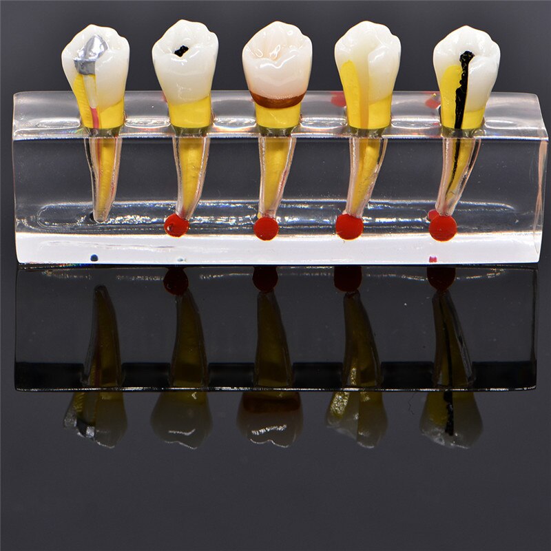 Dental Pulp Restoration Pathological Model with De... – Vicedeal