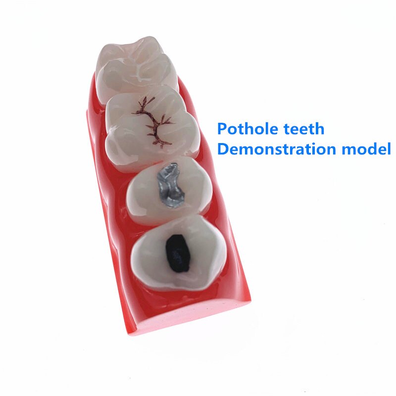 Caries – modèle de démonstration de scellage et d'... – Grandado