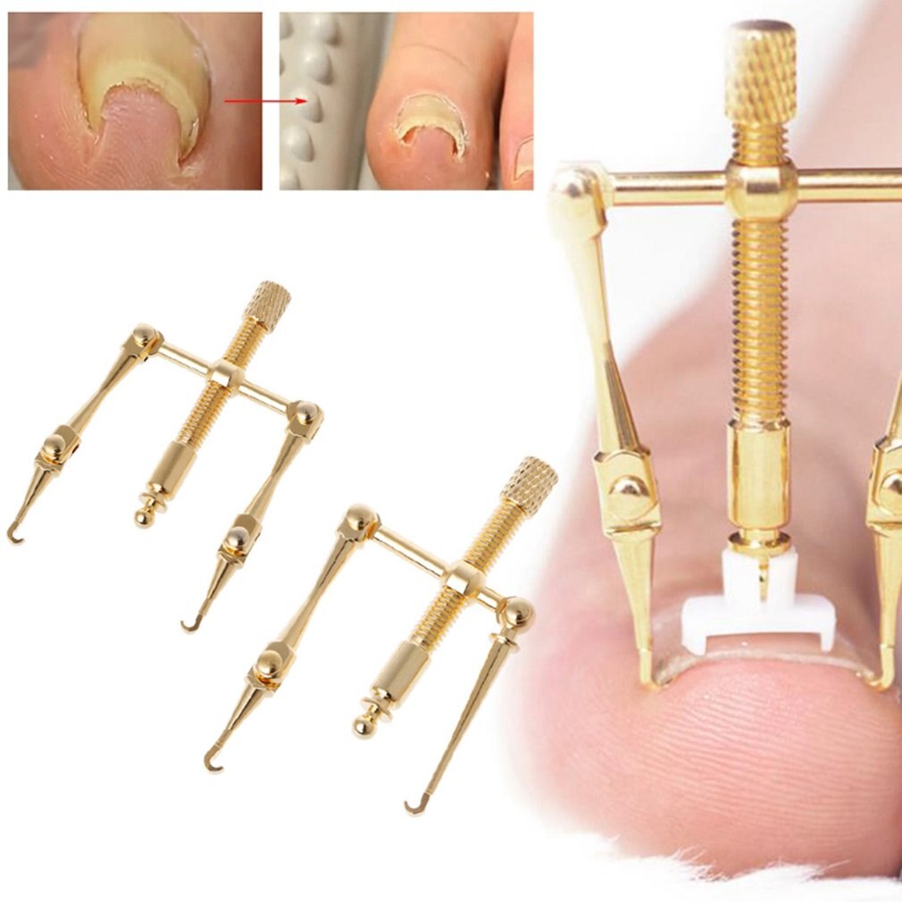 Nail Corrector Ingrown Nail Foot Correction Tool F... – Grandado