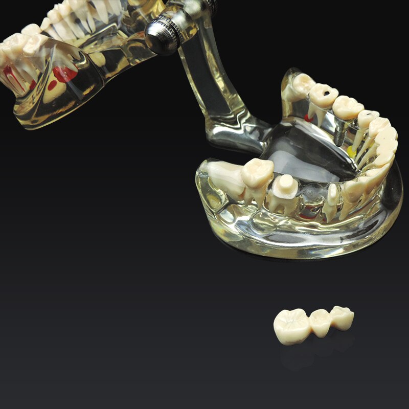 Dental Study Tooth Model Adult Pathological& D... – Grandado