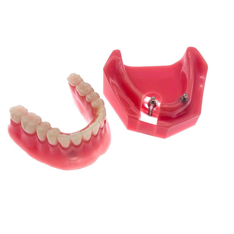 Tanden Model 2 Implantaten Tand Model Dental Infer... – Grandado