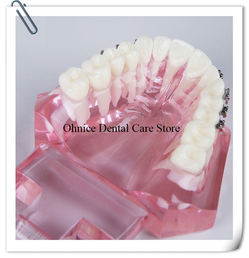 Dental orthodontic teeth model withbrackets buccal... – Grandado