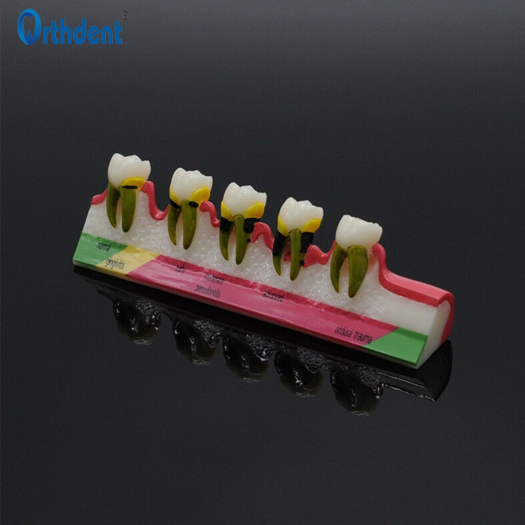 Dental Lab Teeth Model 5-Stage Periodontal Tooth D... – Vicedeal