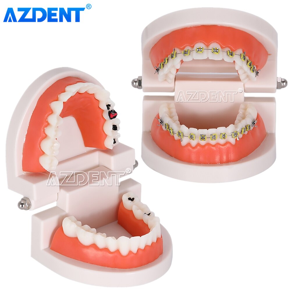 Dental Tooth Decay Teeth Model Dental Orthodontic ... – Vicedeal