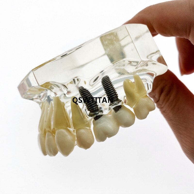 Dental Implant model Upper/Lower jaw with bridge a... – Grandado