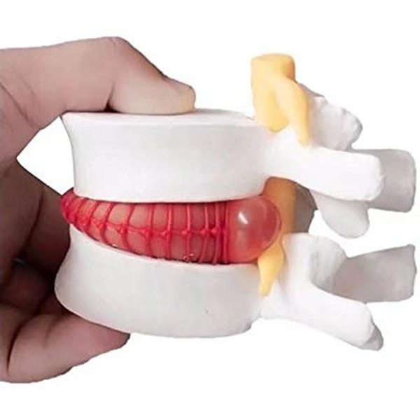 1 Pc Anatomisch Lumbale Hernia Lumbale Wervelkolom... – Vicedeal