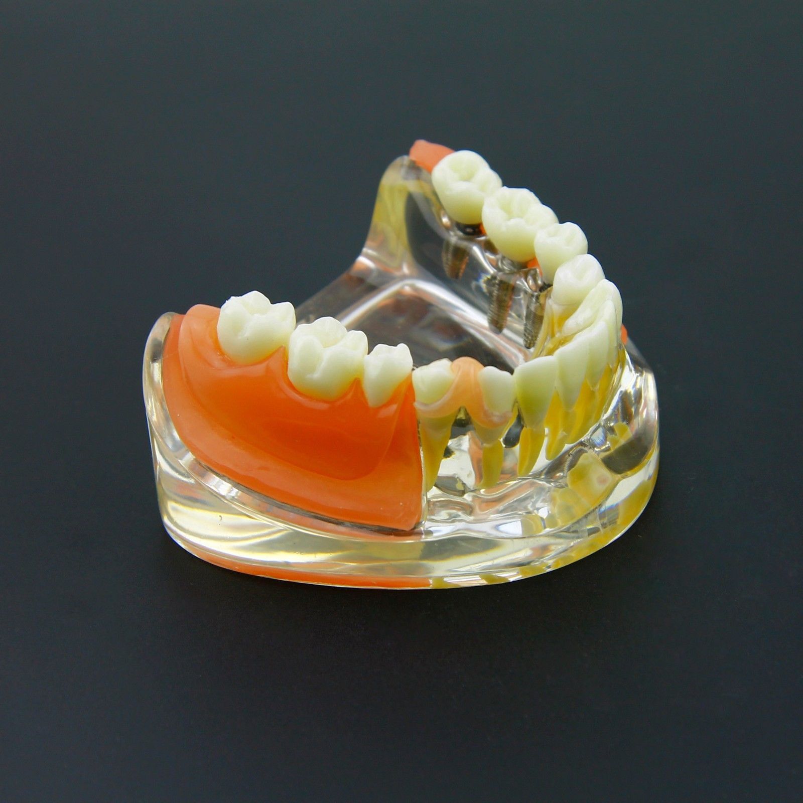 Dental Implant Restoration Teeth Model Removable B... – Vicedeal