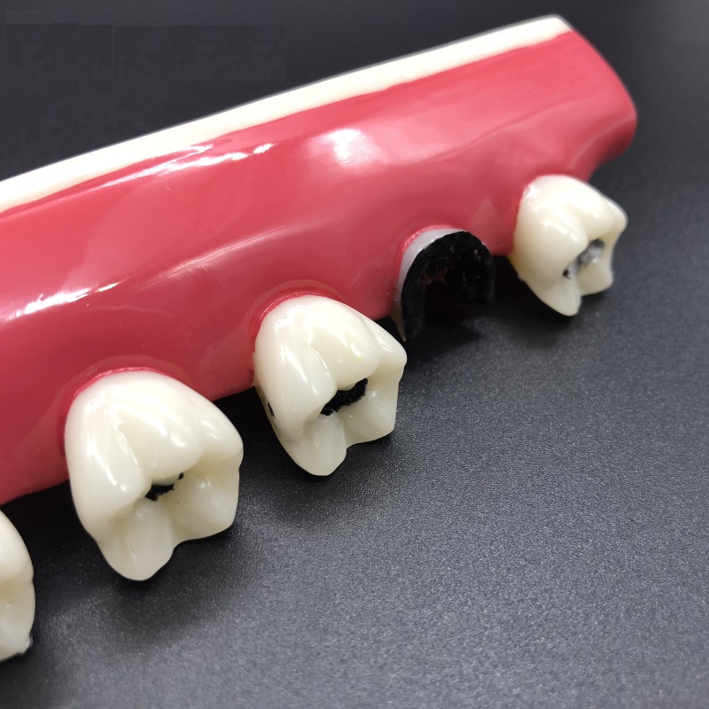 Dental Disease Teeth Model M4011 Demonstrates Prog... – Vicedeal