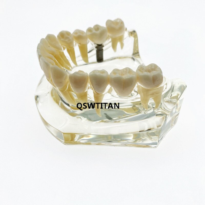 Dental Implant Teeth model Bridge Model With Bridg... – Vicedeal