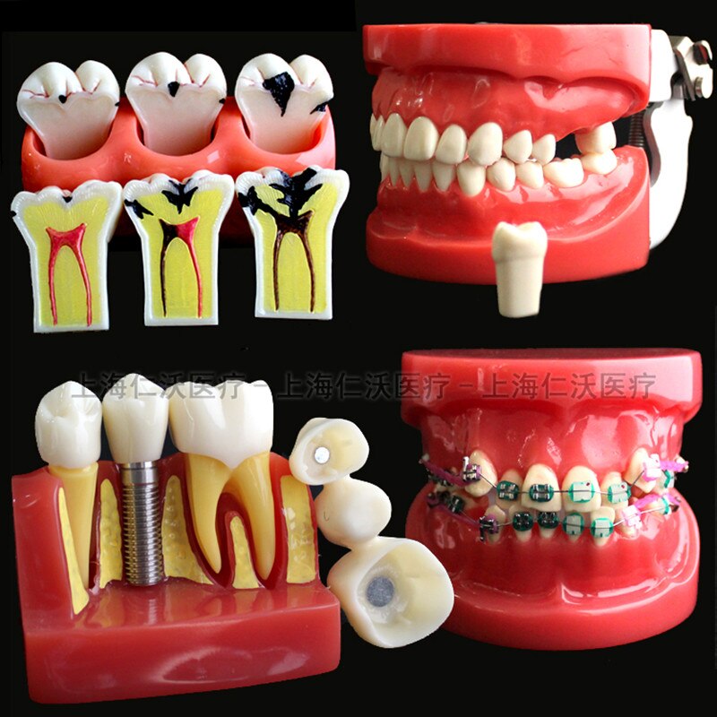 Various Dental Teeth Models Are Used For Teaching ... – Grandado