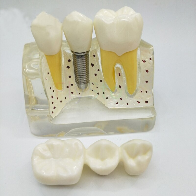 1pc dental demonstration teeth Removable model imp... – Vicedeal