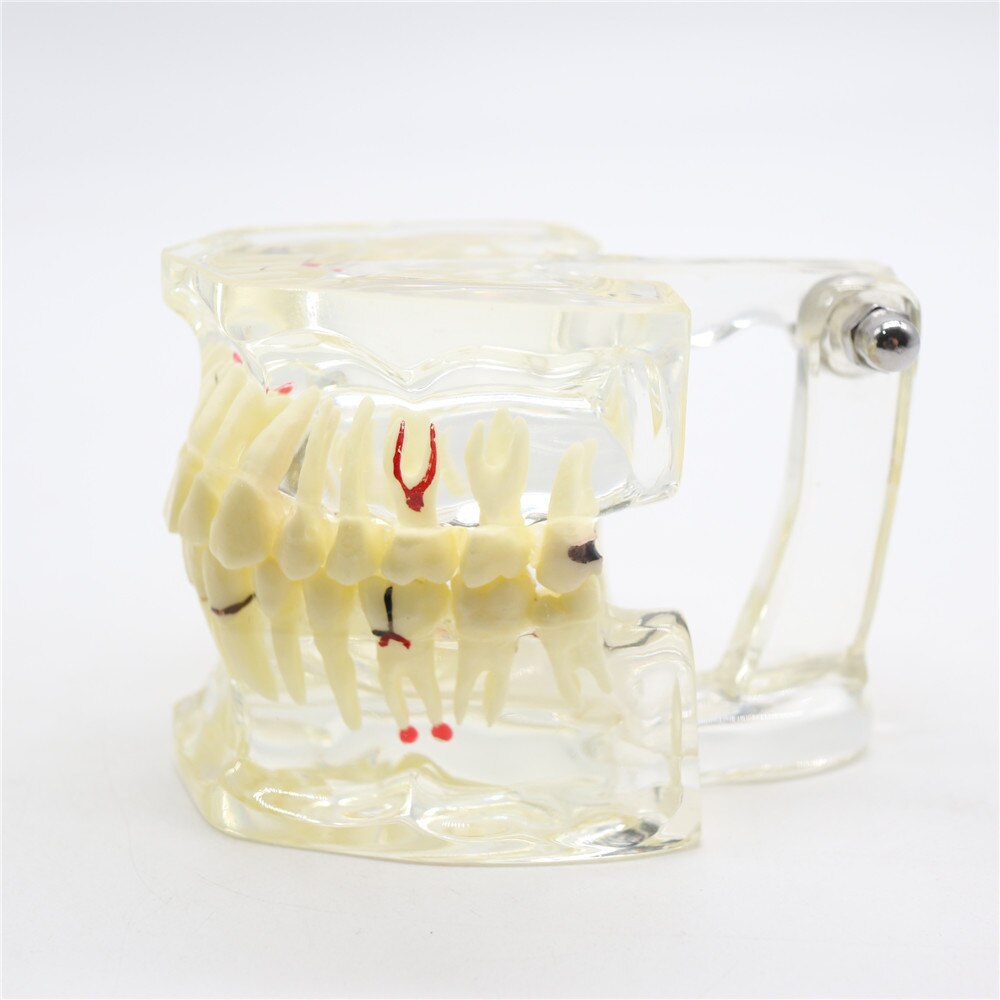 Dental Supplies Implant Disease Tooth Pathological... – Vicedeal