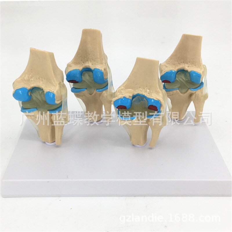 4 pcs Human pathological knee joint model Degenera... – Grandado