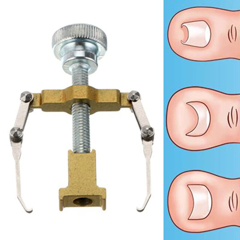 Ingegroeide Teen Nagel Correctie Klem Schaar Nail ... – Vicedeal