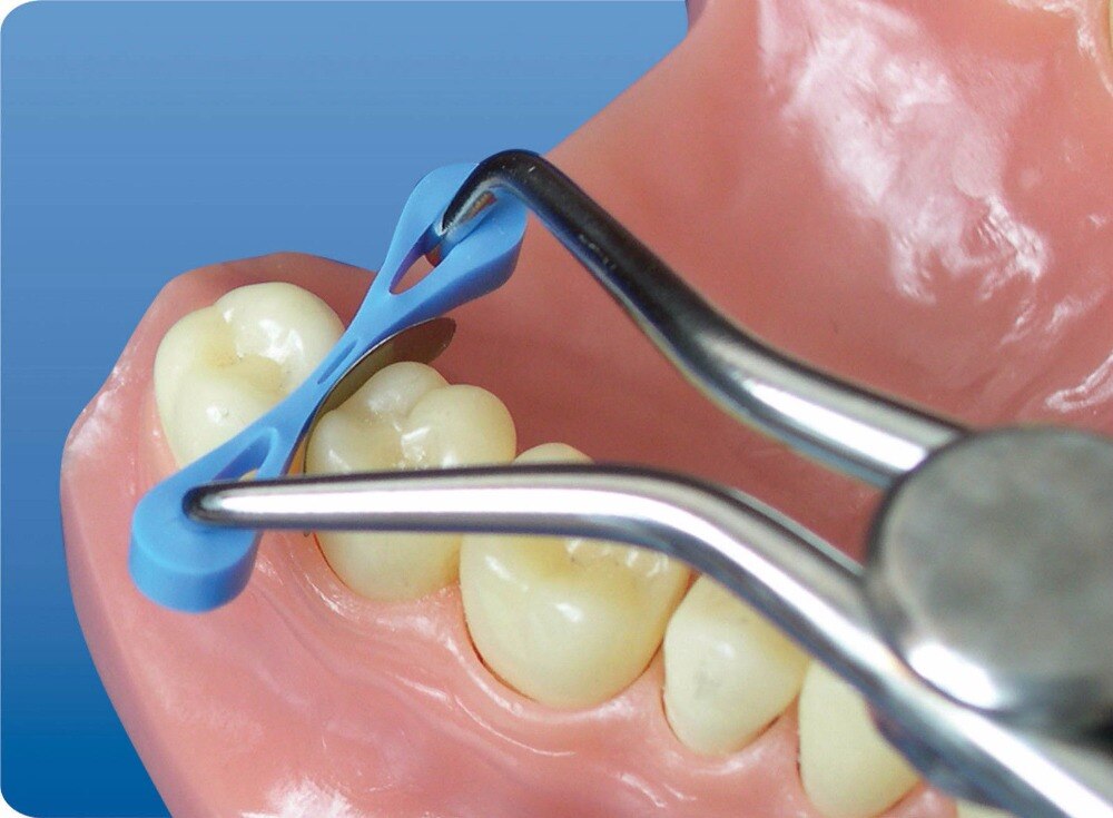 80pcs/box Dental Elastic Fixing Wedges Matrix Matr... – Grandado