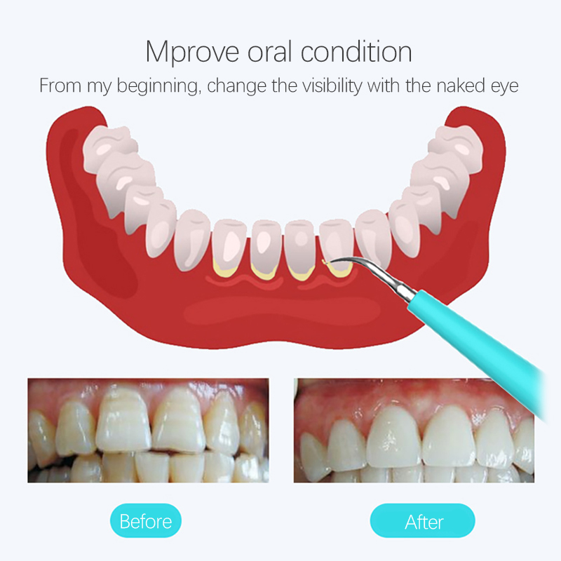 rechargeable dental flosser ultrasonic cleaning de... – Vicedeal