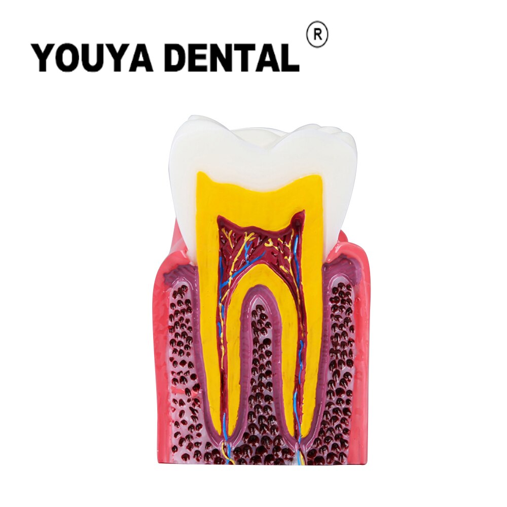 6times Anatomy Molar Model Caries Comparison Teeth... – Grandado