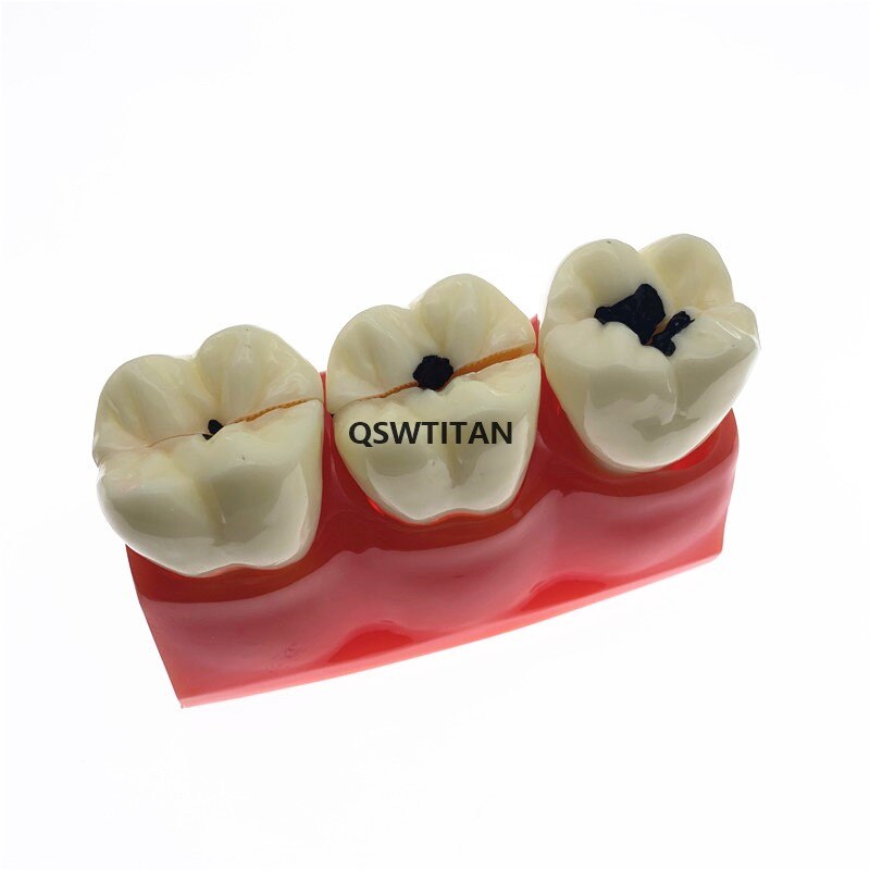 4Times Caries Models Caries teeth model for showin... – Vicedeal