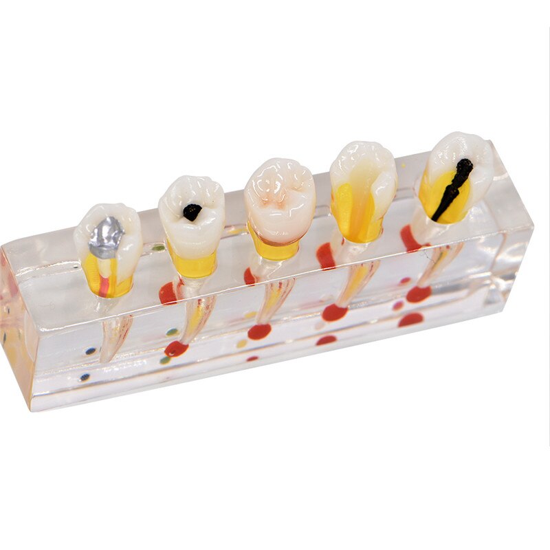 Dental Pulp Restoration Pathological Model with De... – Vicedeal