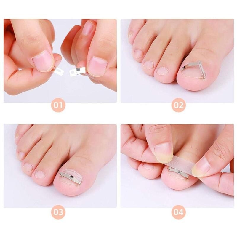 3pcs/set Ingrown Toe Nail Recover Correction Patch... – Grandado