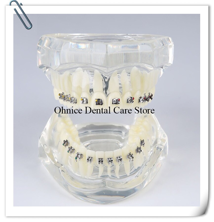 Dental orthodontic teeth model withbrackets buccal... – Vicedeal