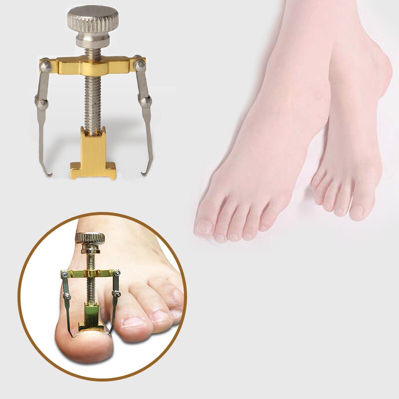 Ingegroeide Teen Nagel Correctie Klem Schaar Nail ... – Vicedeal