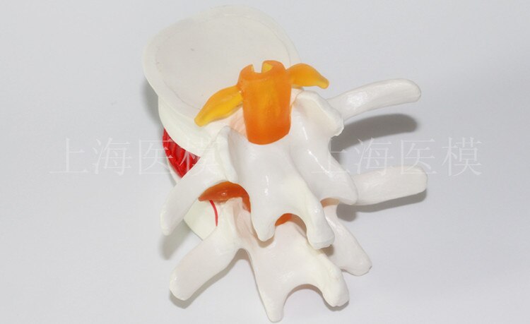 Human lumbar disc herniation model demonstration m... – Grandado