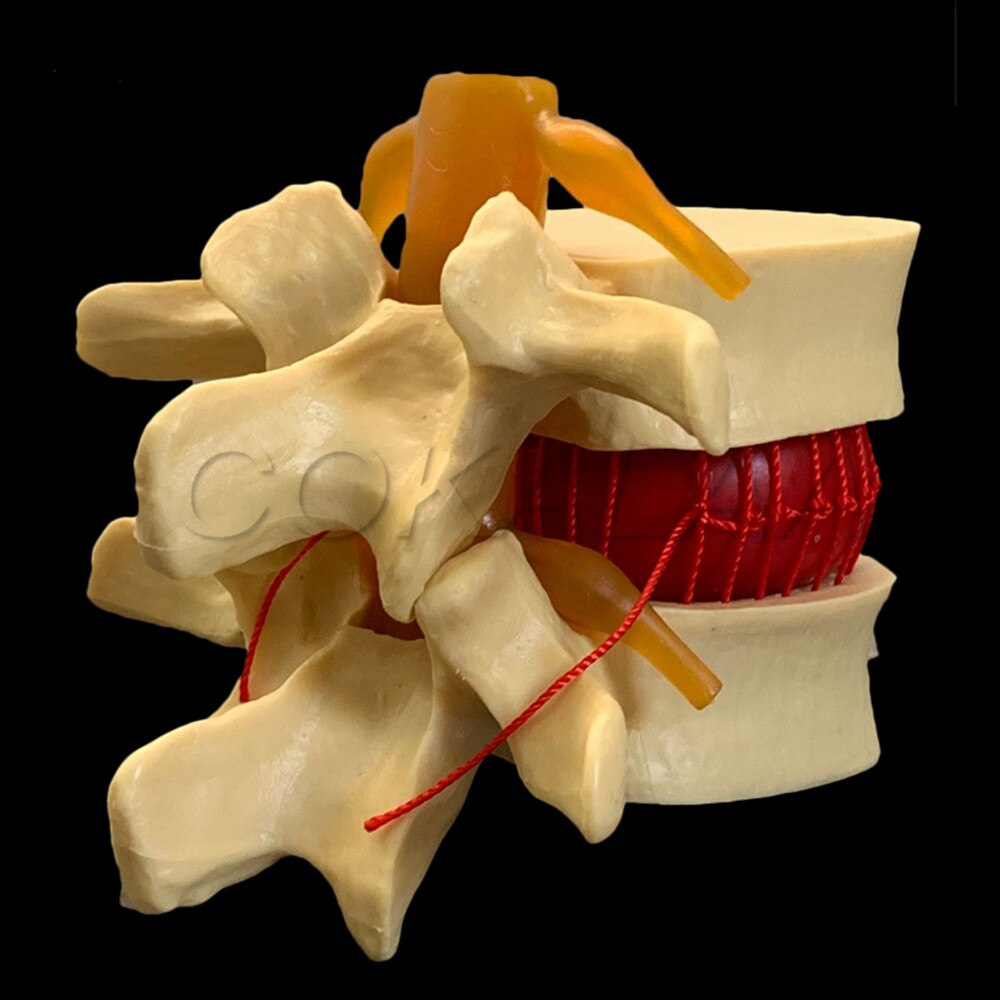 Good 1pcs Human lumbar disc herniation model demon... – Grandado