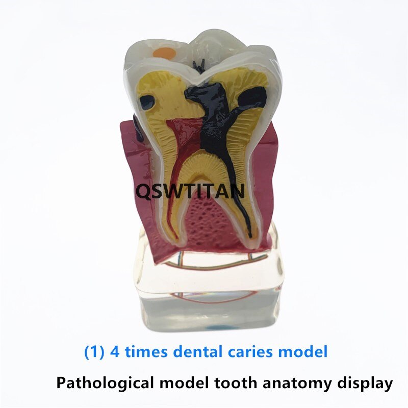 Teeth Model 4 times tooth pathology model Comprehe... – Grandado