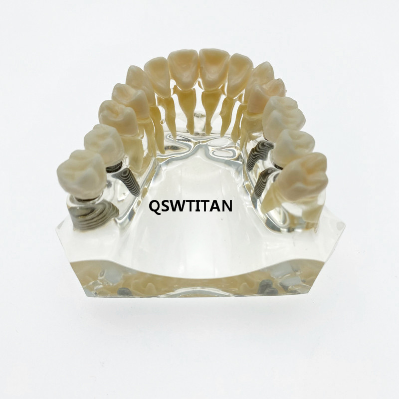 Dental Implant model Upper/Lower jaw with bridge a... – Grandado